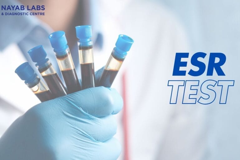 ESR Test Price: Importance, Procedure, and Results - Nayab Labs and ...